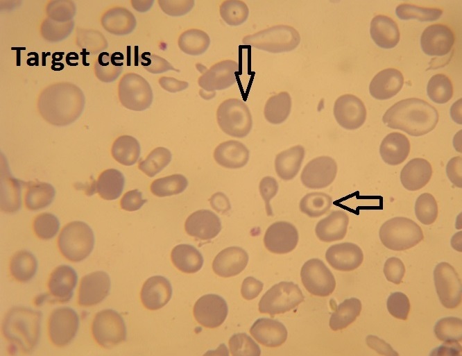 اطلس مرفولوژی گویچه های قرمز خون RBC Morphology