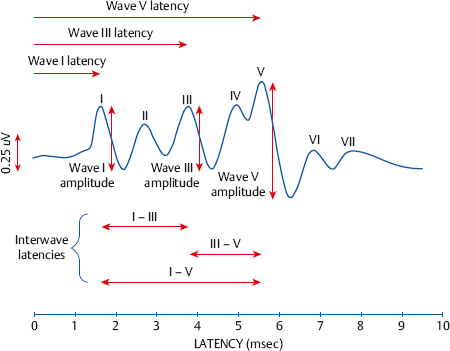 ABR (آزمایش پاسخ شنیداری ساقه مغز)